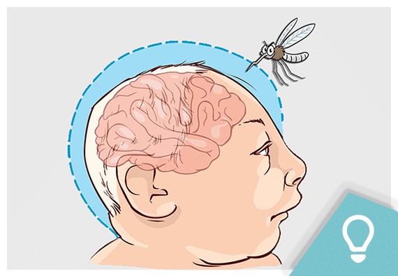 Microcefalia: 18 causas além do Zika vírus