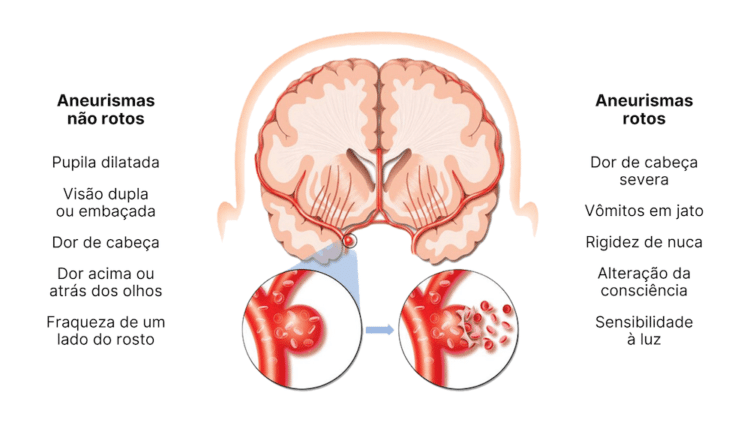 O que é aneurisma cerebral? Quais os sintomas, causas e formas de ...