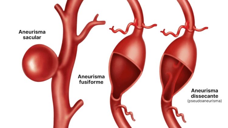 O que é aneurisma cerebral? Quais os sintomas, causas e formas de tratamento? Aneurisma cerebral ...